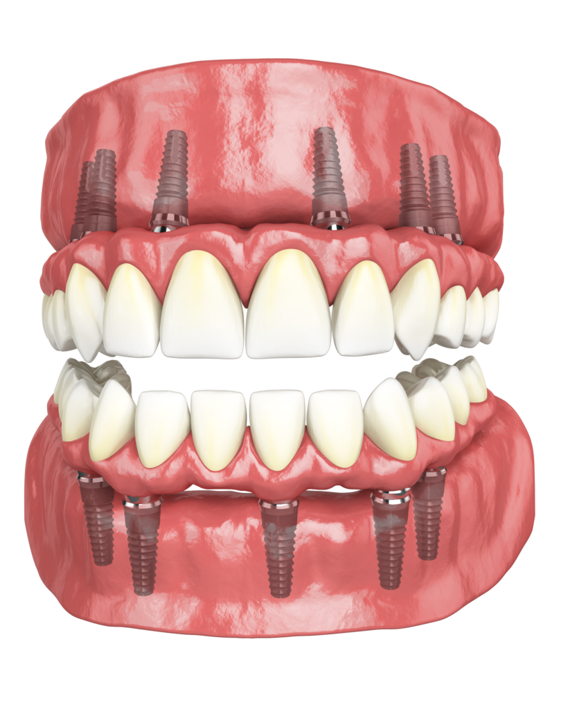 Dental Implants - NYC Smile Spa Upper East Side